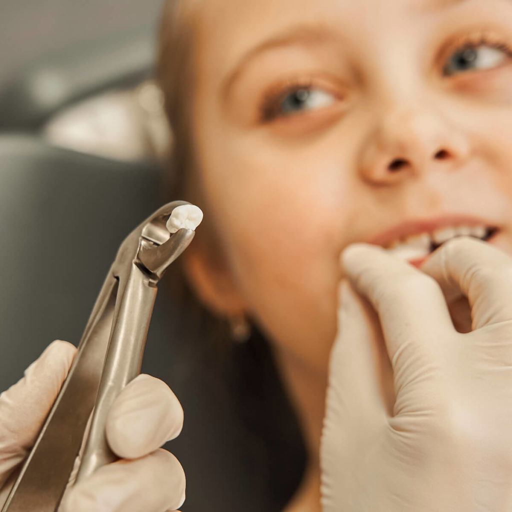 Extracción Dental | Bella Dental